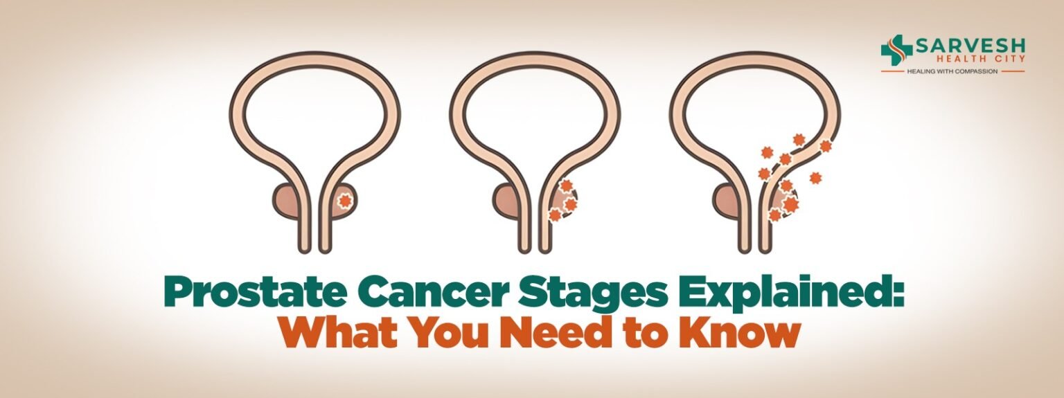 Prostate Cancer Stages Explained: What You Need To Know